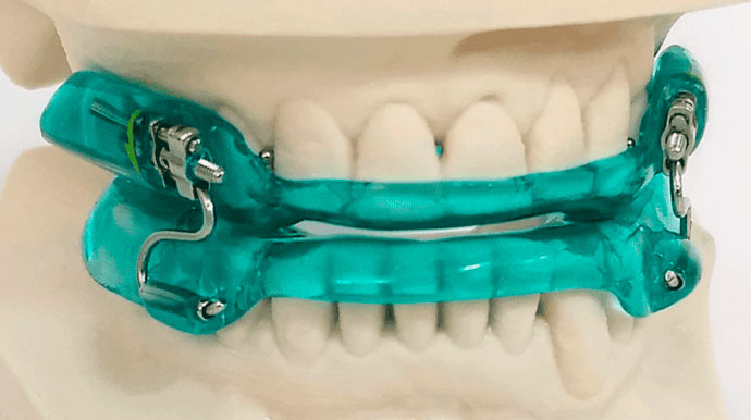 Aparelho Intraoral De Avan o Mandibular Conhe a A Tecnologia Que aparelho-intraoral-de-avan-o-mandibular-conhe-a-a-tecnologia-que